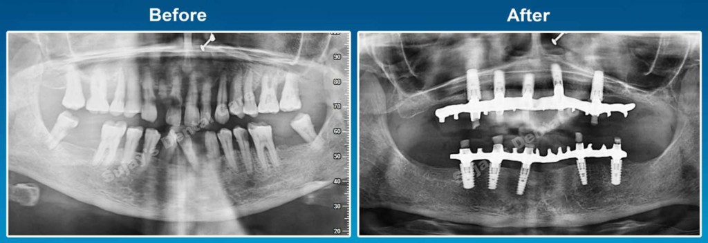 Implant Supported Overdenture – Sujay's Dental Care
