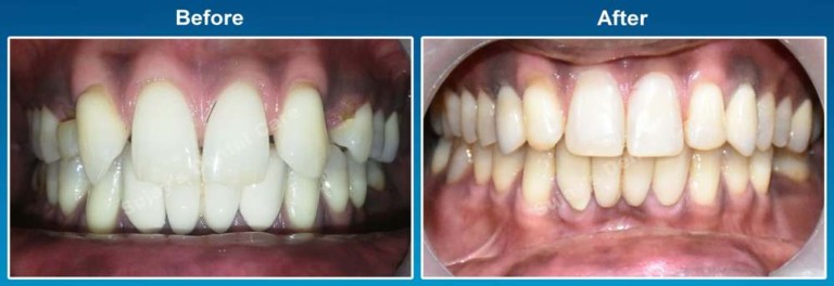 Esthetic correction by tooth contouring and implants - Sujay's Dental Care