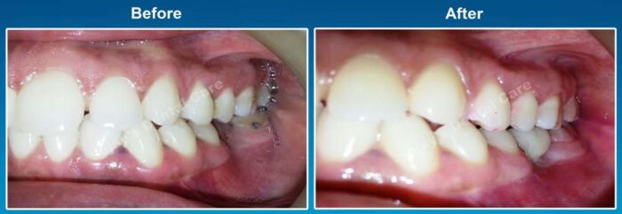 Replacement of A Missing Tooth Using Single Implant - Sujay's Dental Care