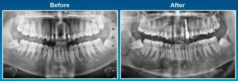 Replacement of a fractured tooth with immediate implant - Sujay's ...
