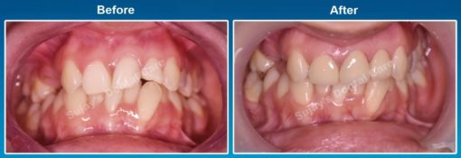 Esthetic correction of upper anteriors - Sujay's Dental Care