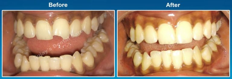 Esthetic composite restoration - Sujay's Dental Care