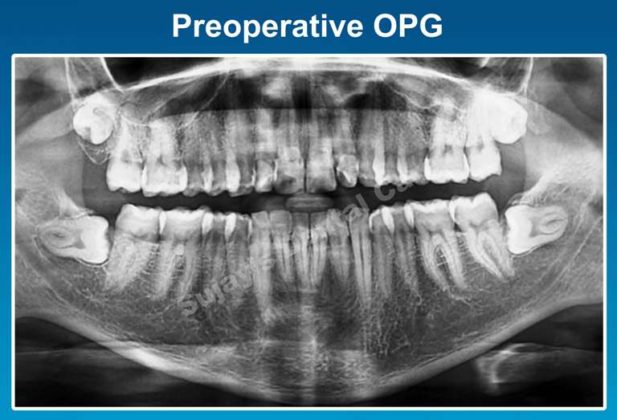 Smile Designing - Sujay's Dental Care