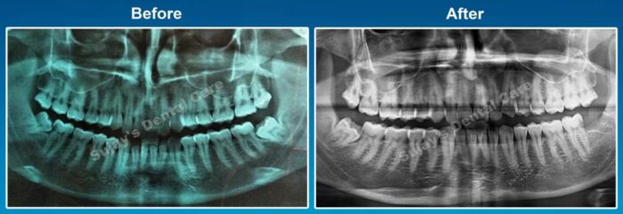 Wisdom Tooth Extraction - Sujay's Dental Care
