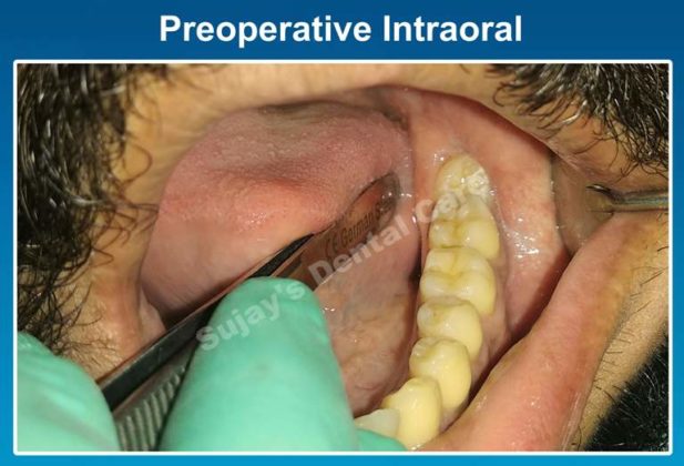 Wisdom tooth extraction - Sujay's Dental Care