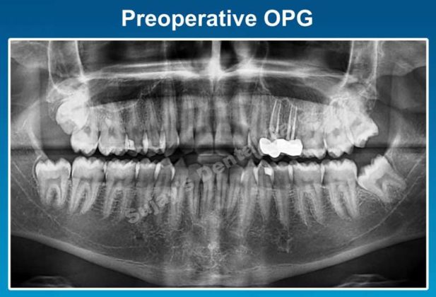Composite restoration of opposing class – II cavities - Sujay's Dental Care