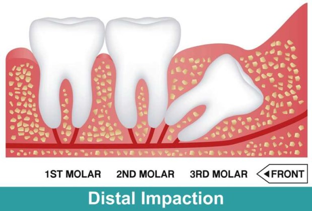 Wisdom Tooth Extraction - Sujay's Dental Care