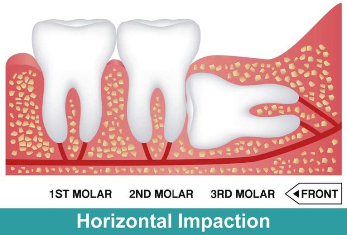 Wisdom Tooth Extraction - Sujay's Dental Care
