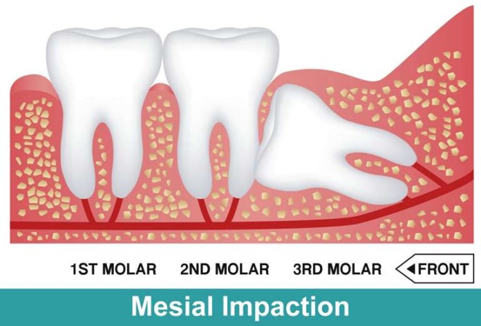 Wisdom Tooth Extraction - Sujay's Dental Care