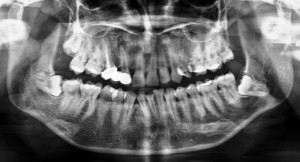 Orthopantomogram ( OPG X- Ray ) – Sujay's Dental Care