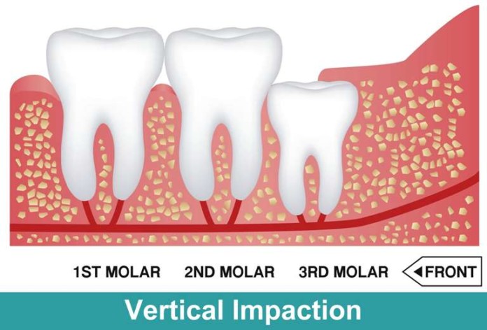 Wisdom Tooth Extraction - Sujay's Dental Care